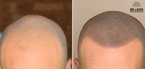 Scalp Micropigmentation and head scars – How to get rid of the problem ...