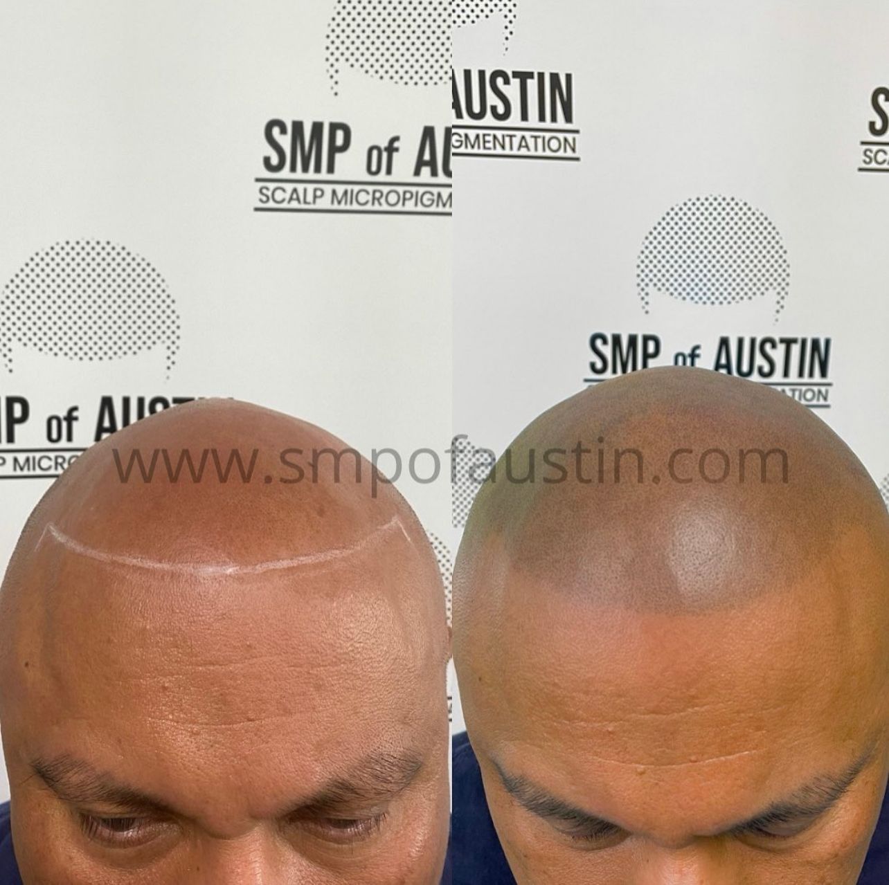 Male Pattern Baldness: What are the early signs – SMP of Austin